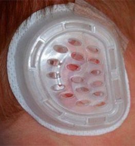 Ear Molding - Non-Surgical Ear Correction | Kids Clinic Singapore