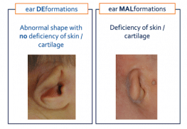 Ear Molding - Non-Surgical Ear Correction | Kids Clinic Singapore